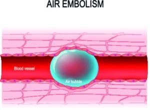 Oxygens | UK HyperBaric Oxygen Therapy Chambers